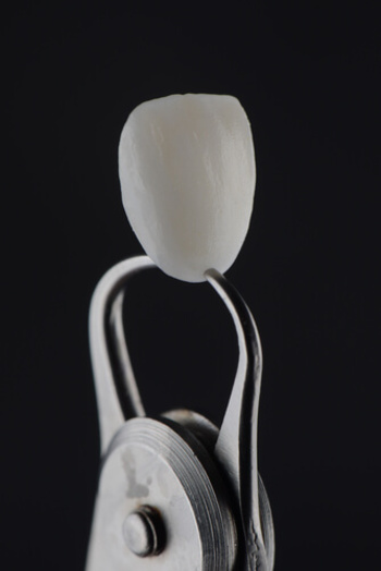 Natural Looking Veneers | Sydney Laser Dental Care