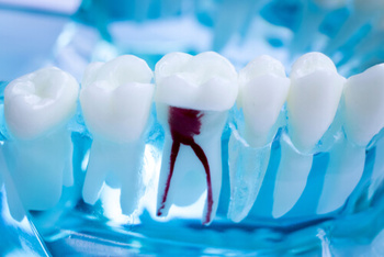 What Is a Root Canal? Explore the Procedure and Benefits