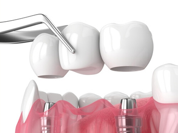 Dental Bridge Cost: Understanding Pricing and Treatment